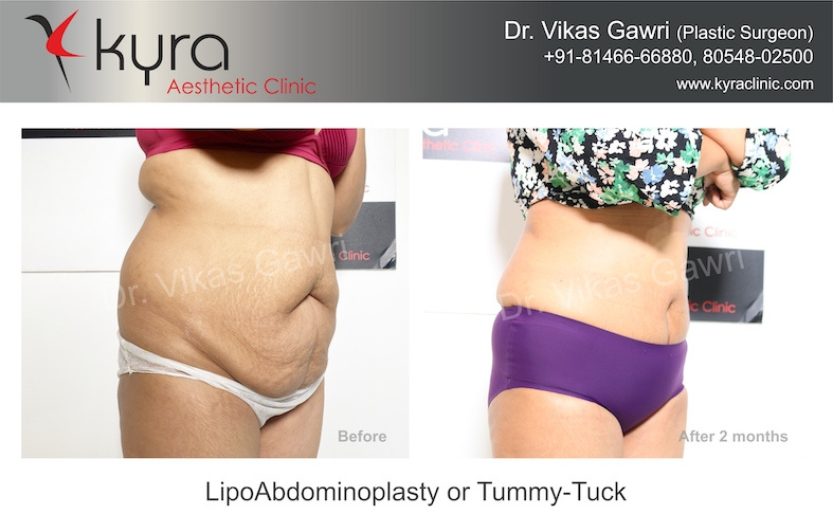 Extended Tummy Tuck 0599